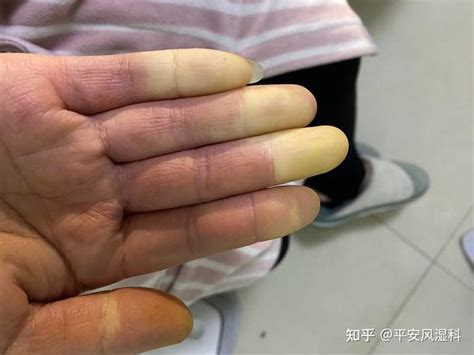 手指遇冷就变色误当冻疮，3年后手指尖发黑坏死才知是这种病——雷诺现象 知乎