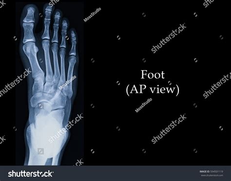 142 Ap Foot Xray 이미지 스톡 사진 및 벡터 Shutterstock