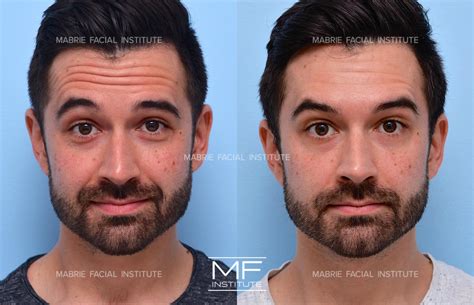 Forehead Wrinkles And Frown Lines Before And After Pictures Case 629