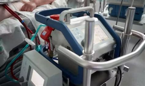 Patients With Obesity Receiving Ecmo For Ards Had Lower Mortality Rates