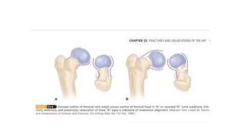 Intracapsular Fracture Neck Of Femur Pptx