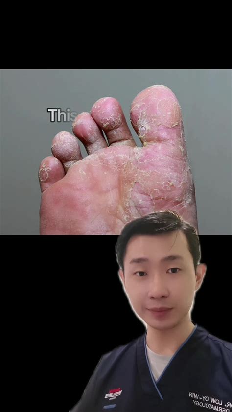 Ringworm Of The Body Tinea Corporis Askdrlow Dermatologist Askdrlowdywin