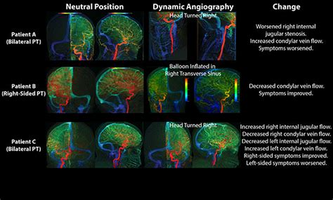 Pulsatile Tinnitus Causes And Treatments Ucsf Radiology
