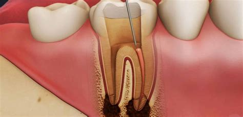 Post Root Canal Care Important Steps After Your Treatment
