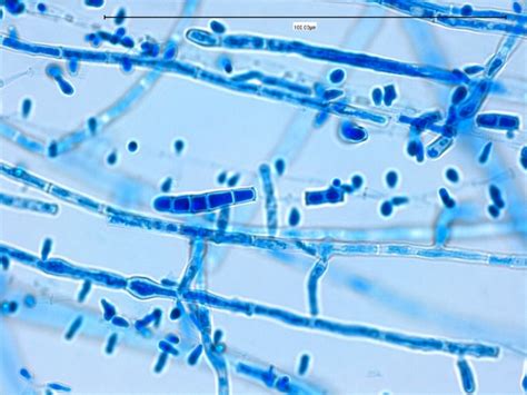 Fun With Microbiology Whats Buggin You Trichophyton Tonsurans