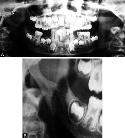 Three Months After The Postoperative OPG Revealing There Was No