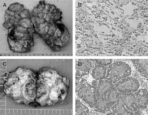 The Patient Underwent Radical Adrenalectomy Of The Right Adrenal Mass