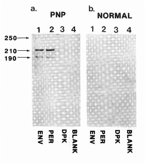 Figure 1 From Envoplakin And Periplakin Are The Paraneoplastic