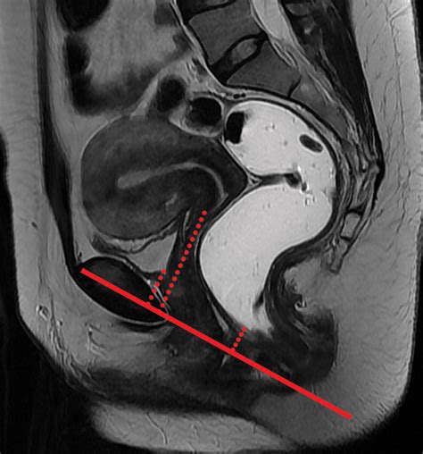 Mri Anatomy Female Pelvis At Martin Huey Blog
