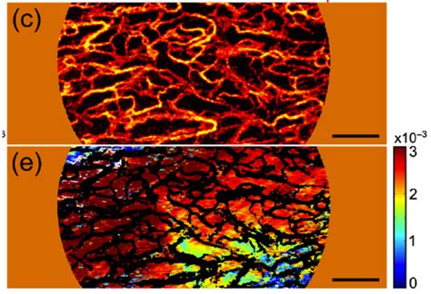 Imaging Of Skin Birefringence For Human Scar Assessment Using