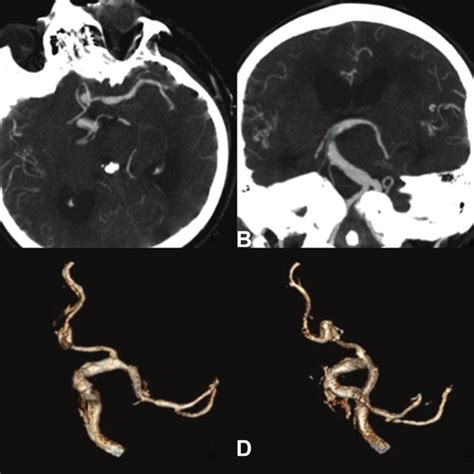PDF Anterior Communicating Artery Aneurysm Uncommon Hemorrhagic Presentation A Case Report
