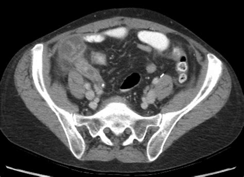 Transvaginal US Vs CT In Non Pregnant Premenopausal Women Presenting To The ED Clinical Impact