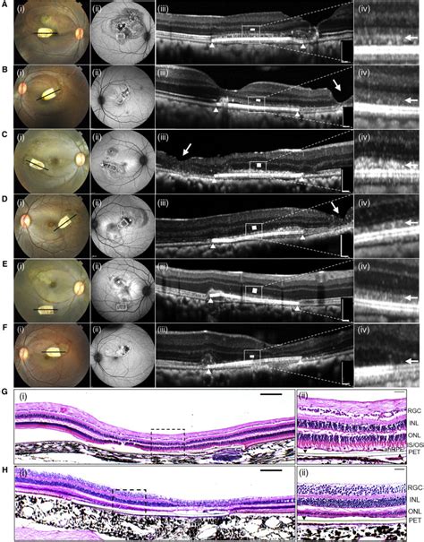 Surgical Transplantation Of Human Rpe Stem Cell Derived Rpe Monolayers