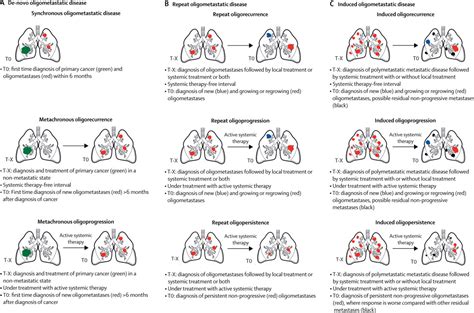Characterisation And Classification Of Oligometastatic Disease A European Society For