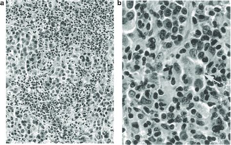Photomicrograph Showing Inflammatory Response In Subcutaneous