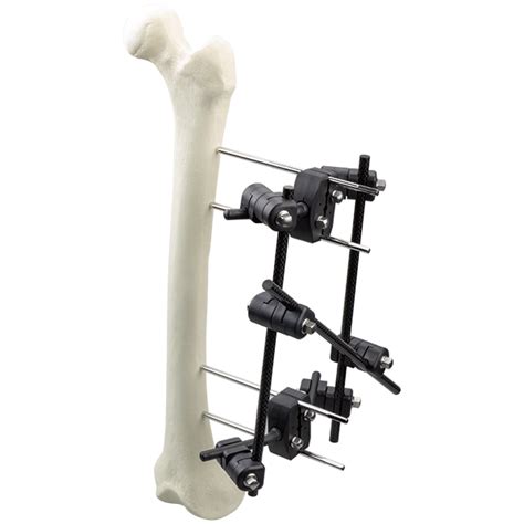 China Φ Series External Fixation Fixator Femoral unilateral reinforcement frame factory and