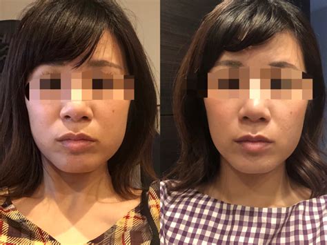 湘南美容クリニックでエラボトックス体験！歯ぎしり・肩こり治したい わんだふるマイホーム！