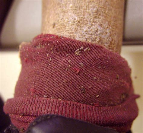 Lice Pictures Symptoms Faqs