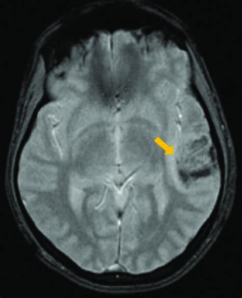 Gradient Echo Brain Sequence Repeated On Day 6 Of Admission Revealed