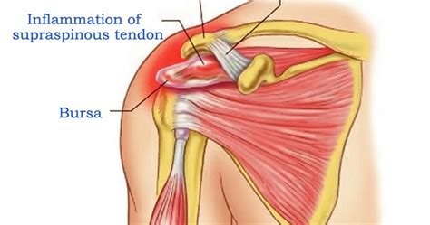 Inflamed Shoulder Tendons