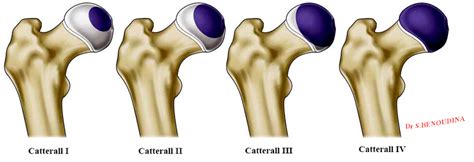 Legg Calve Perthes Disease Physiopedia