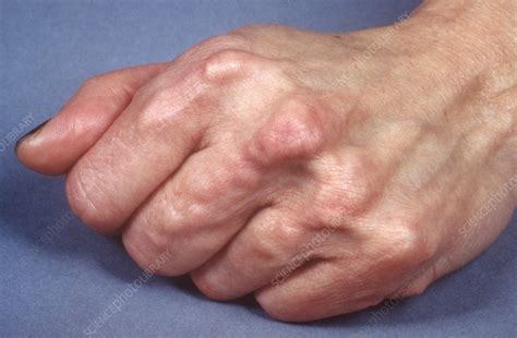 Hyperlipidemia Stock Image C0144424 Science Photo Library