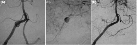42 Year Old Male With Asymptomatic Right Vertebral Artery Fusiform