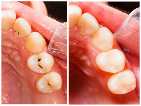 Benefits Of Composite Resin Fillings Smilepoint Dental