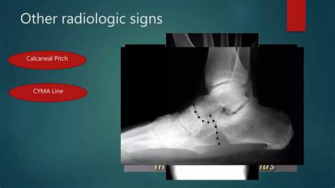Flat Foot Tibialis Posterior Tendon Dysfunction And Accessory