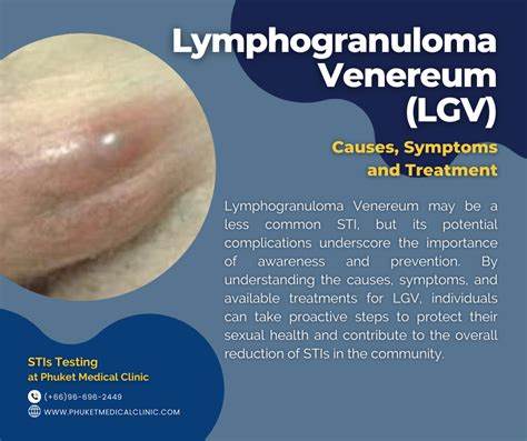 Lymphogranuloma Venereum Lgv Causes Symptoms And Treatment Phuket