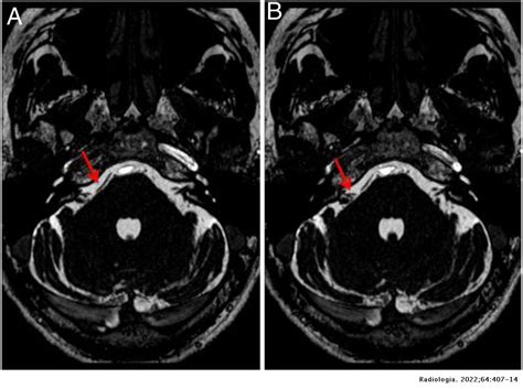 Vascular Loop In The Cerebellopontine Angle Clinical Radiological Correlation Radiología