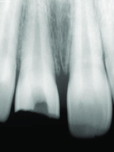 Radiograph Of Maxillary Right Central Incisor Showing Radiolucency Of