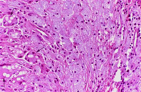 Granular Cell Tumor