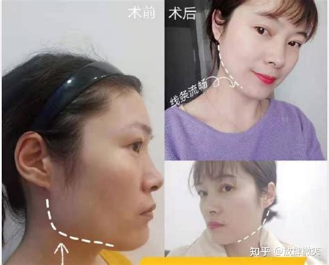 南京下颌角比较好的医生，南京吴国平、金柱翰做下颌角怎么样？南京正颌医生推荐 知乎