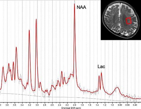 Mr Spectroscopy Of The Parietal Subcortical White Matter Point
