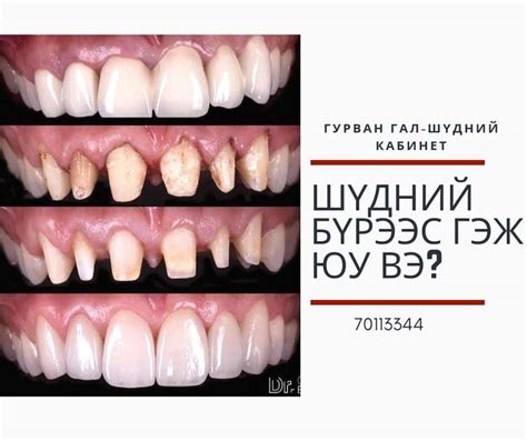 Шүдний бүрээс гэж Гурван гал эмнэлэг Gurvan Gal Hospital Facebook