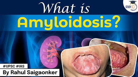 What Is Amyloidosis Faqs