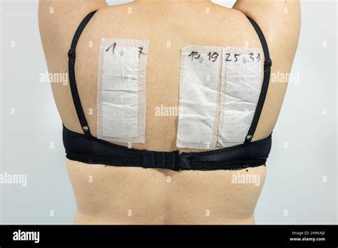 Patch Tests Stuck On The Back Of A Woman Test To Detect Skin Allergens Contact Allergens