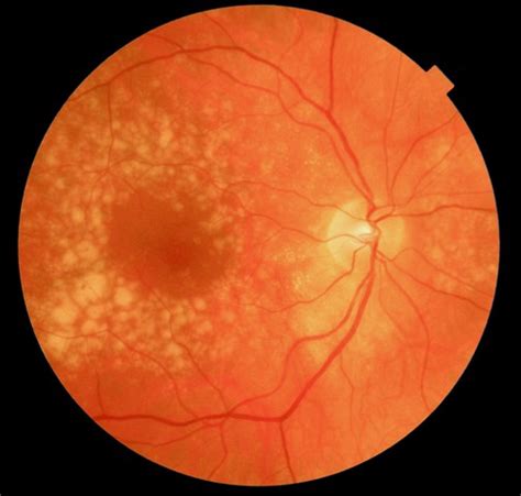 OCT Tomógrafo de Coherencia Óptica Opticare Equipos Oftalmológicos