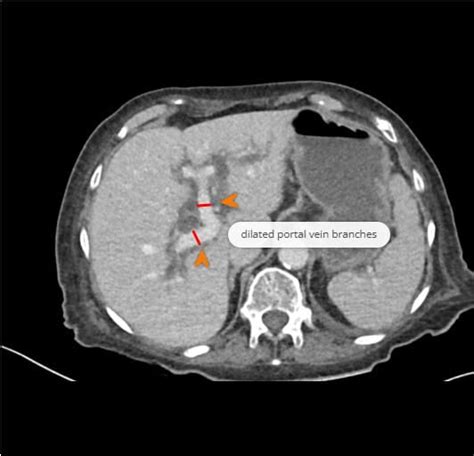담낭염 Vs 담관염 Cholecystitis Vs Cholangitis 의학당