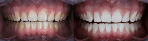 33 Dental Photo Comparison Before After Teeth Whitening Images Stock