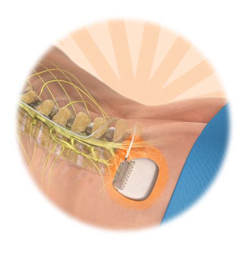 Spinal Cord Stimulation Scs Procedure In Minnesota
