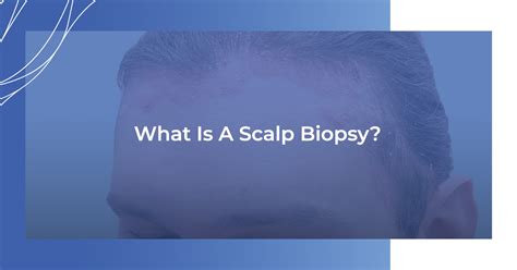 What Is A Scalp Biopsy Rhrli