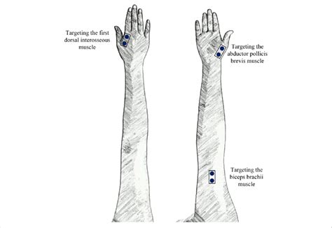 The Placement Of Three Surface Electromyogram Emg Sensors That