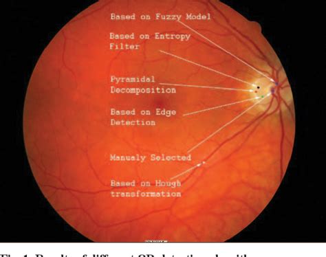 Figure 1 From Automatic Detection Of The Optic Disc Using Majority Voting In A Collection Of