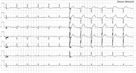 Electrocardiogram Of The Patient With I AVL V5 V6 Lead ST T Changes