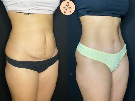 Tummy Tuck Before And After Pictures Case 75 San Antonio Texas Dr