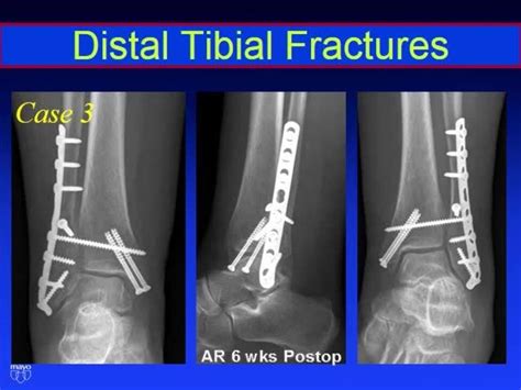 Distal Tibia Fracture
