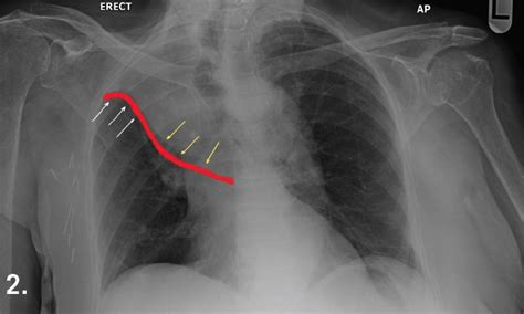 Small Cell Lung Cancer With Worsening Opacification Of The Right Upper