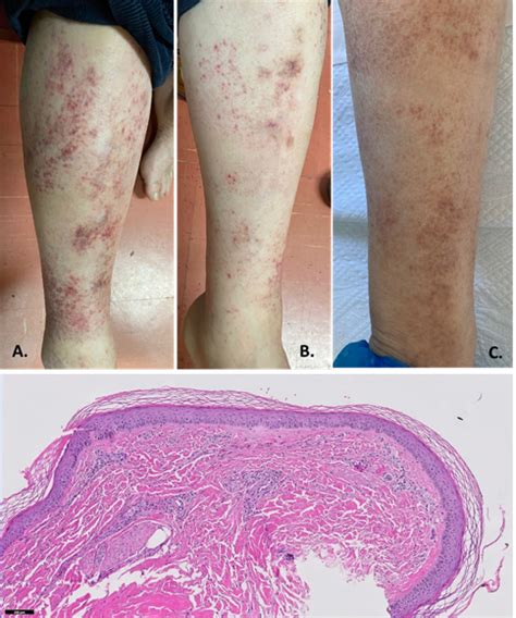 Remember Leptospirosis Two Cases Report Brazilian Journal Of Case